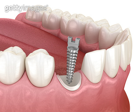Dental steel post installation in to incisor tooth. Dental endodontic ...
