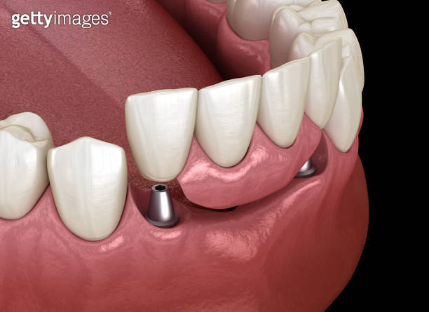 Frontal teeth bridge supported by implants. Medically accurate 3D ...