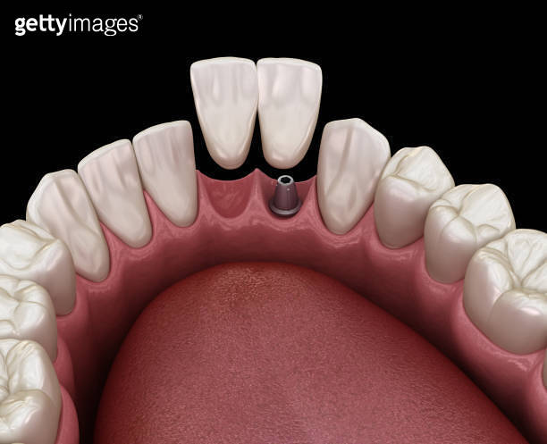 Cantilever bridge implant based, frontal tooth recovery. Medically ...