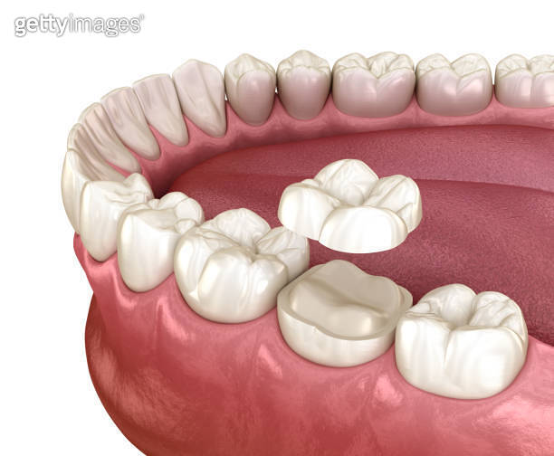 Onlay ceramic crown fixation over molar tooth. Medically accurate 3D ...