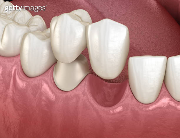 Cantilever bridge made from ceramic, frontal tooth recovery. Medically ...