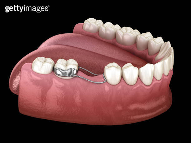 Space Maintainer Unilateral keeps from teeth shift deformatiuon after ...