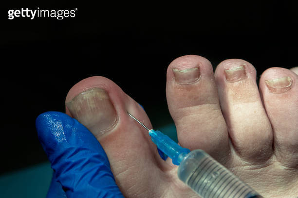 Fungal toenail infection. A doctor wearing blue medical gloves gives an ...