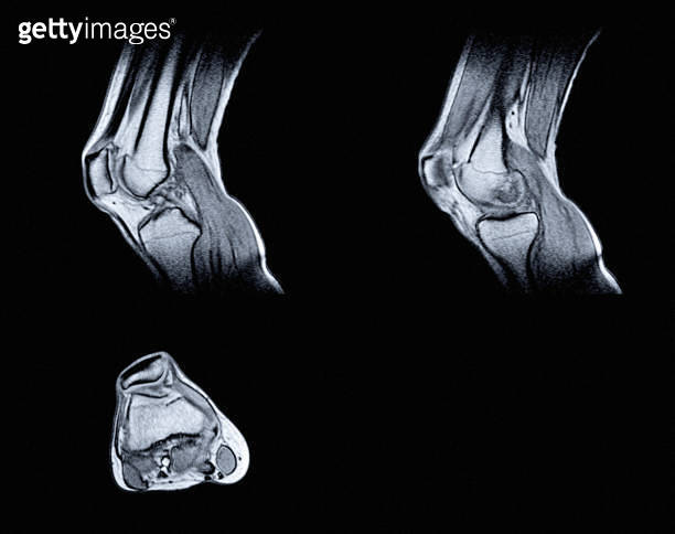 Magnetic resonance imaging (MRI) of right knee. Closed injury of the ...