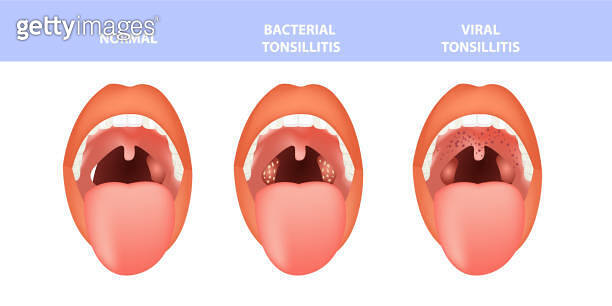Open mouth, normal and Tonsillitis bacterial and viral. Angina, pharyngitis and tonsillitis ...