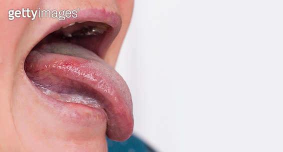Woman with a disease and redness of the tongue. Glossitis and ...