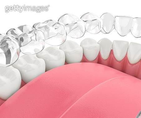 3d render of invisalign removable retainer with lower jaw 이미지 ...