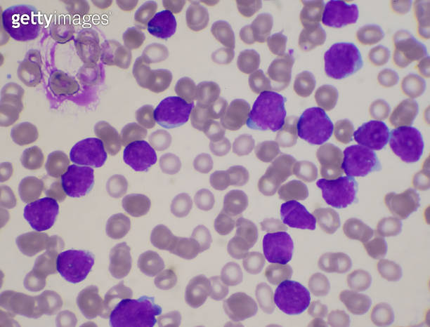Moderate blast cell of white blood cells in blood smear.Leukemia blood ...