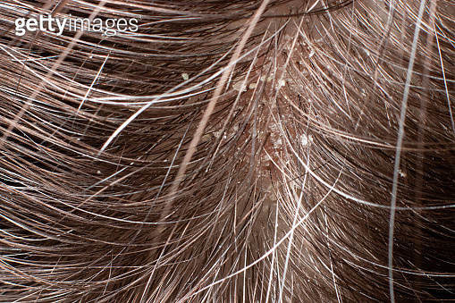 Macro photo of human hair with dandruff. Head wounds and itching, hair ...