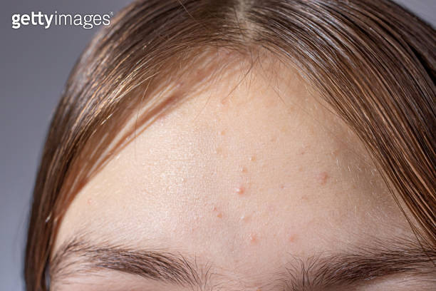Acne on the forehead of a teenage girl - skin problems in children ...