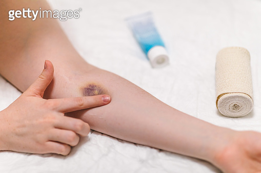 First aid for bruising. Large hematoma bruise on the arm, ointment and ...