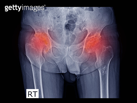 Film X-ray hip radiograph show femoral head collapse from Avascular ...