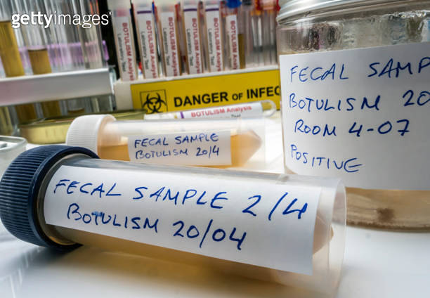 Fecal sample of a person infected with botulism, infection in tin cans ...