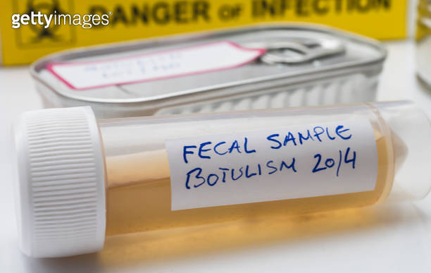 Fecal sample of a person infected with botulism, infection in tin cans ...