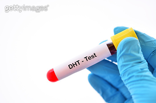 Blood sample for DHT hormone test 이미지 (1256134181) - 게티이미지뱅크