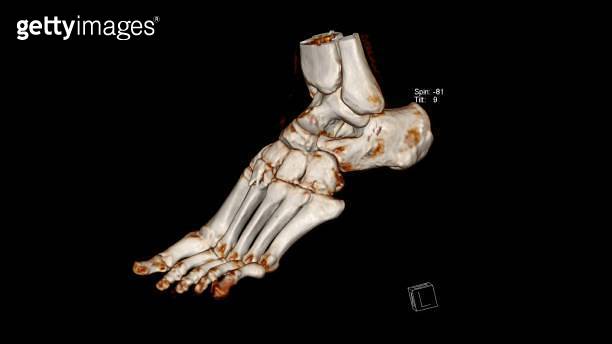Computed Tomography Volume Rendering examination of the Foot ( CT VR ...
