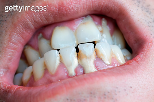 Tooth's a man smoking bad. Man smokes a cigarettes have tooth decay and ...