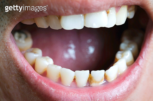 Tooth's a man smoking bad. Man smokes a cigarettes have tooth decay and ...