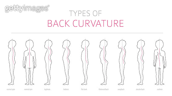 Types of kid`s back curvature. Medical disease infographic. Outline ...