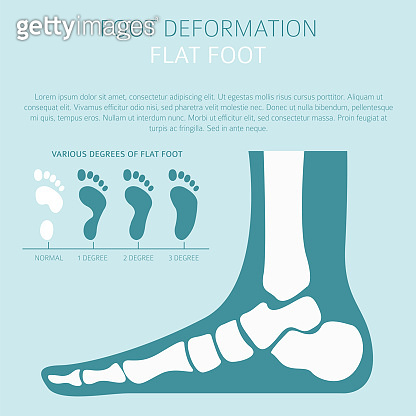 Foot deformation as medical desease infographic. Causes of Flat foot ...