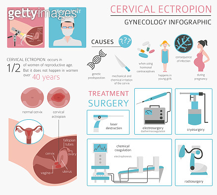 Cervical ectropion. Ginecological medical desease infographic 이미지 ...