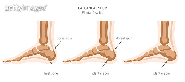 Calcaneal spur. Plantar fasciitis set. Medical desease infographics ...