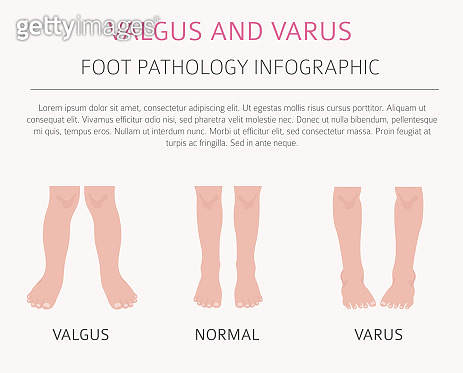 Foot deformation as medical desease infographic. Valgus and varus ...