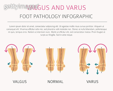 Foot deformation as medical desease infographic. Valgus and varus ...