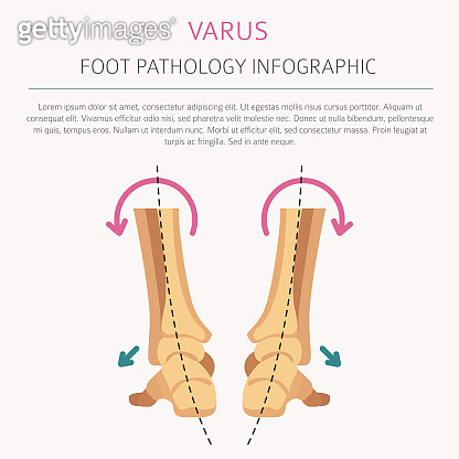 Foot deformation as medical desease infographic. Valgus and varus ...