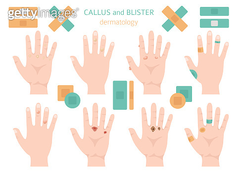 Callus, corn and blister feet and hands. Dermatology. Medical desease ...