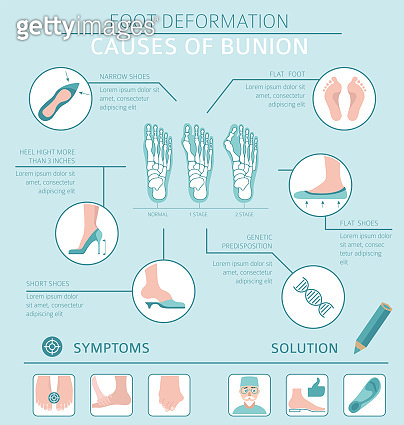 Foot deformation as medical desease infographic. Causes of bunion ...