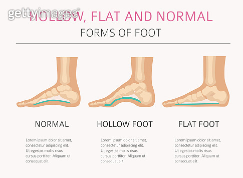 Foot deformation types, medical desease infographic. Hollow, flat and ...