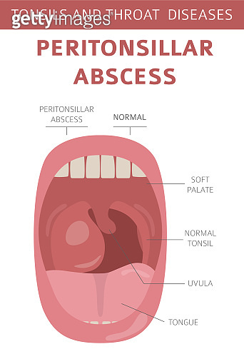 Tonsils and throat diseases. Peritonsillar abscess symptoms, treatment ...