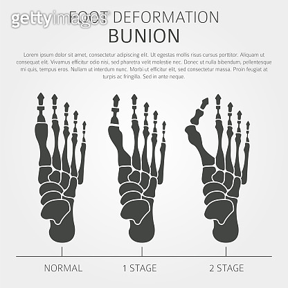 Foot deformation as medical desease infographic. Causes of bunion ...
