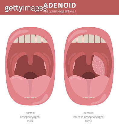 Nasal and throat, nasopharynx diseases. Adenoids diagnosis and treatment medical infographic ...