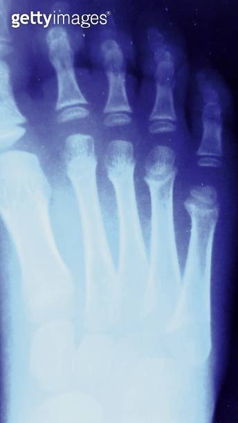 X-ray image of a fracture of the foot and phalanges of the right toes ...