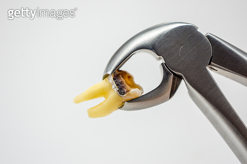 caries-affected destroyed with a large cavity removed human tooth in ...