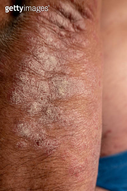 Psoriasis Is A Chronic Inflammatory Autoinmune Skin Disease 이미지