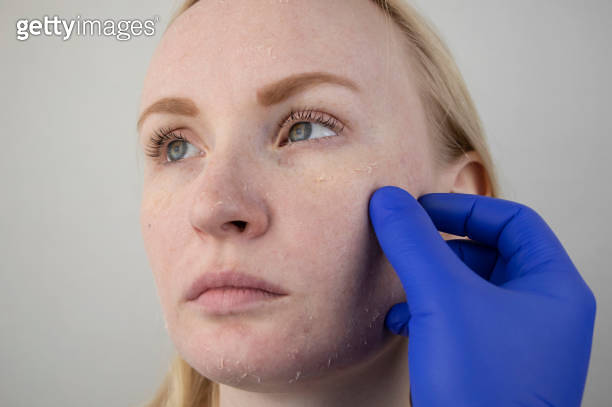 A woman examines dry skin on her face. Peeling, coarsening, discomfort ...