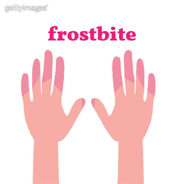 Frostbite. Hands with different skin colors due to low temperature and ...
