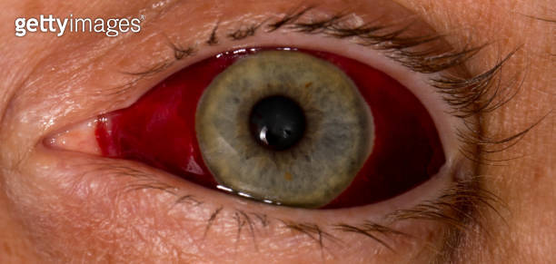 Human eye with subconjuctival hemorrhage, broken blood vessel, close up ...