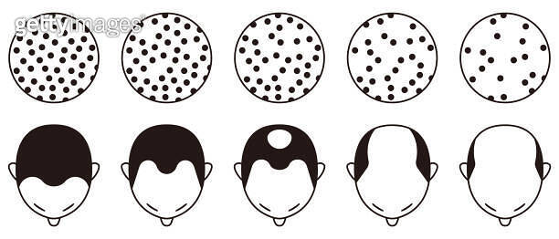 Information chart of hair loss stages and types of baldness illustrated ...