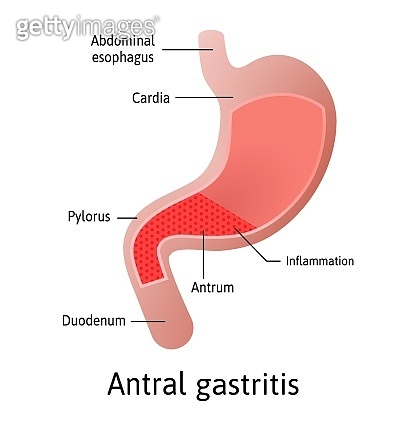 Antral Location of Gastritis, an inflammation of the lining of the ...