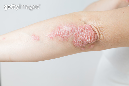 Acute psoriasis on elbows is an autoimmune incurable dermatological ...