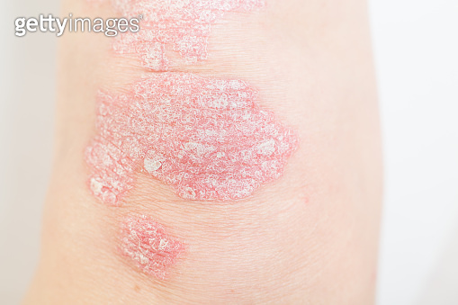 Acute psoriasis on the knees is an autoimmune incurable dermatological ...