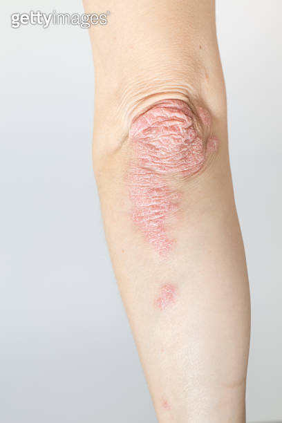 Acute psoriasis on elbows is an autoimmune incurable dermatological ...