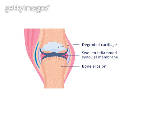 Diagram of knee joint with osteoarthritis, flat vector illustration ...