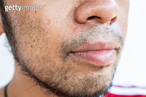 Close-up shot of a whitehead acne occur on men's skin. 이미지 (1279575795 ...
