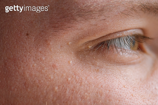 Milia (Milium) - pimples around eye on skin. Eyes of young man with ...