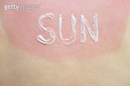 Red skin after a sunburn and the word sun from sunblock (1255193337 ...